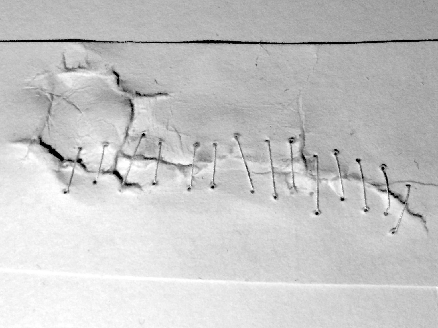 Innere Naht Gerissen Symptome - Baby Schwanger